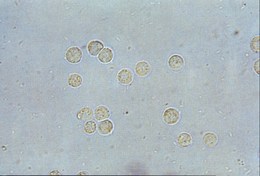 urine-WBC - Fluid,Crystal,cast, - 서해대학 임상병리과 총동문회