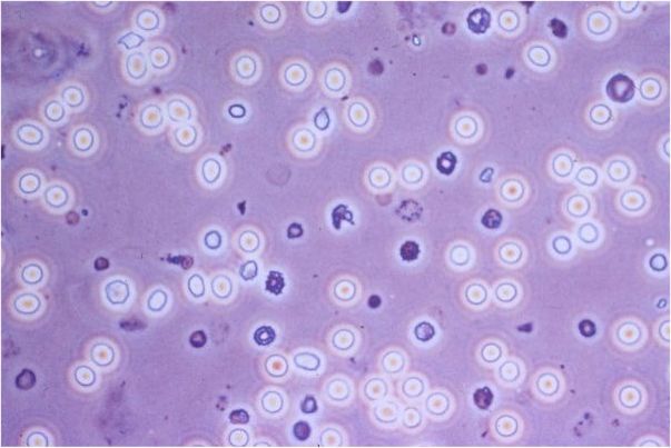 변형(이형)적혈구(dysmorphic RBC) - 요검사(UA) - 임상화학검사학회 자료실