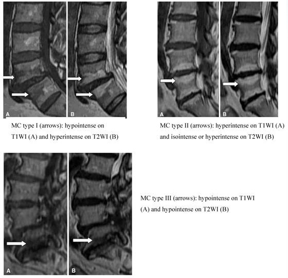 허리디스크 MRI판독법. 골단판 퇴행성변화 3단계 과정(modic change) - x-ray,ct, mri 진단 - 치료적 ...
