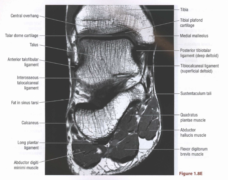 ankle MRI 탐구 - 다시 정리해야.. 입체적 3D 구조로 - x-ray,ct, mri 진단 - 치료적 맞춤운동, 비타미네 ...