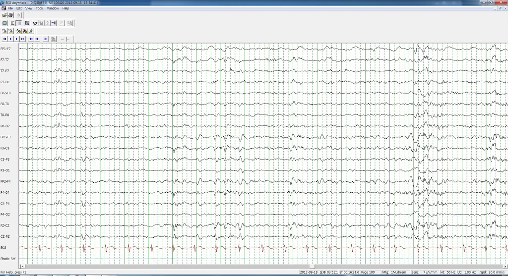 cases - 간질, 경련 - 두신경과