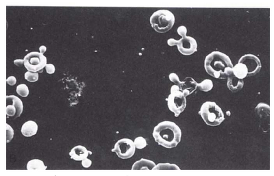 변형(이형)적혈구(dysmorphic RBC) - 요검사(UA) - 임상화학검사학회 자료실