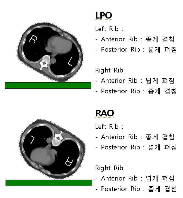 Rib series oblique [RAO=LPO, RPO=LAO] - X-선 방 (CR&DR) - 방사선과해우소 시즌3#