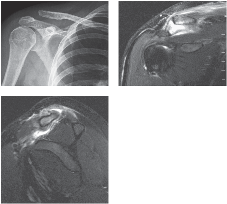 견쇄관절 분리/탈구 (Acromioclavicular Joint Separation/Dislocation) - x-ray,ct ...
