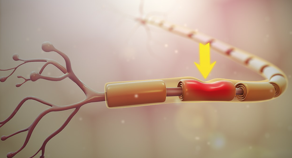 Re: nerve injury - neuropraxia, axonotmesis, neurotmesis - 치료 도구 및 테크닉 ...