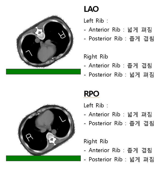 Rib series oblique [RAO=LPO, RPO=LAO] - X-선 방 (CR&DR) - 방사선과해우소 시즌3#