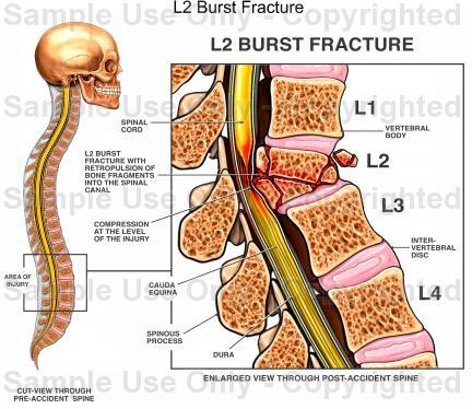방출성 골절 (L2 Burst Fracture) - x-ray,ct, mri 진단 - 치료적 맞춤운동, 비타미네, 영성 연구소