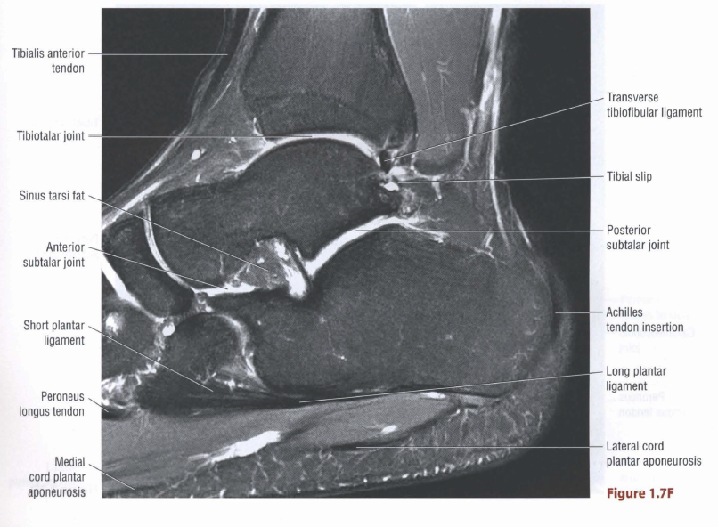 ankle MRI 탐구 - 다시 정리해야.. 입체적 3D 구조로 - x-ray,ct, mri 진단 - 치료적 맞춤운동, 비타미네 ...