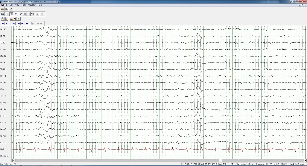 cases - 간질, 경련 - 두신경과