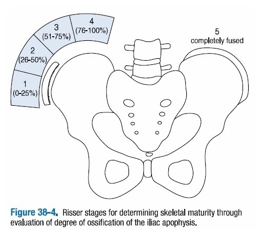 비외상성 척추 단순 방사선 촬영 - 척추측만증 (Scoliosis) - x-ray,ct, mri 진단 - 치료적 맞춤운동 ...