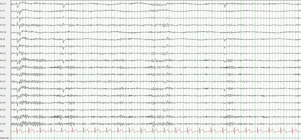 cases - 간질, 경련 - 두신경과