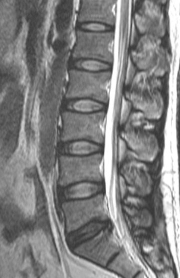 허리디스크 MRI판독법. 골단판 퇴행성변화 3단계 과정(modic change) - x-ray,ct, mri 진단 - 치료적 ...