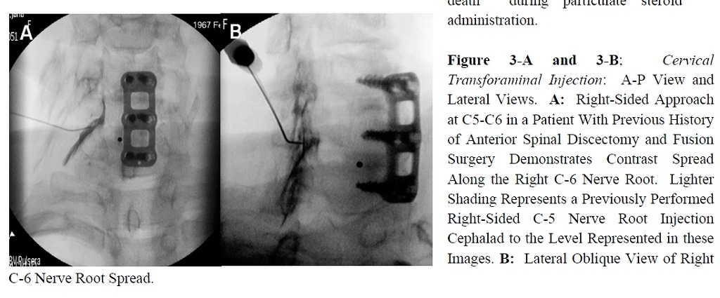 Spinal Injections for the Diagnosis and Treatment of Chronic Pain - 영상 ...