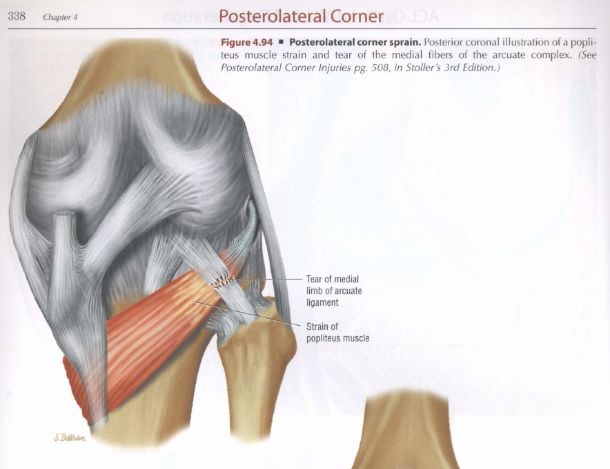 무릎의 posterolateral corner 손상 - 정리해야 - knee - 치료적 맞춤운동, 비타미네, 영성 연구소