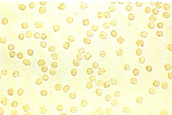 변형(이형)적혈구(dysmorphic RBC) - 요검사(UA) - 임상화학검사학회 자료실