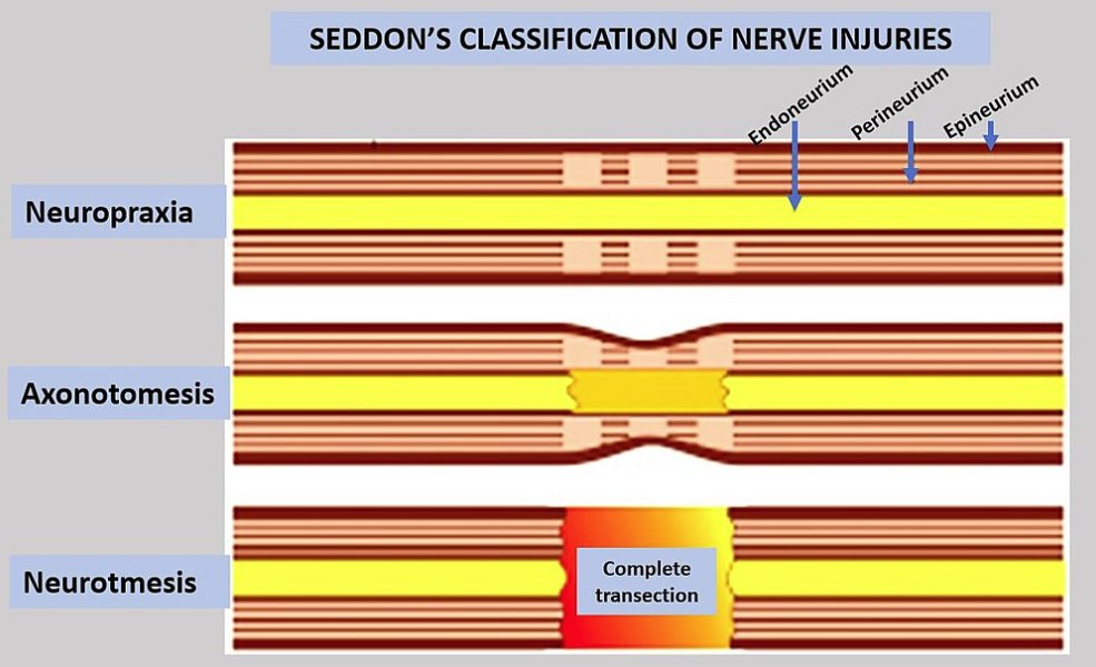 Re: nerve injury - neuropraxia, axonotmesis, neurotmesis - 치료 도구 및 테크닉 ...